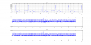 Android Based ECG monitoring / health monitoring